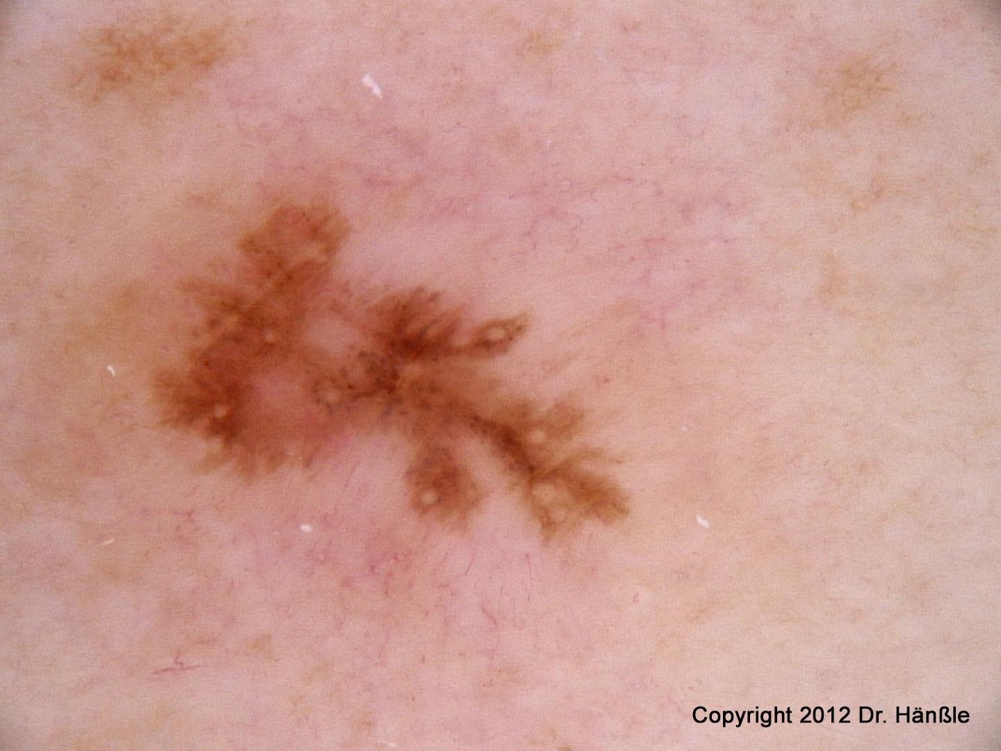 FotoFinder - Hautzentrum Burgdorf